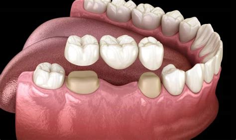 Choosing Porcelain Dental Bridges Key Factors To Consider