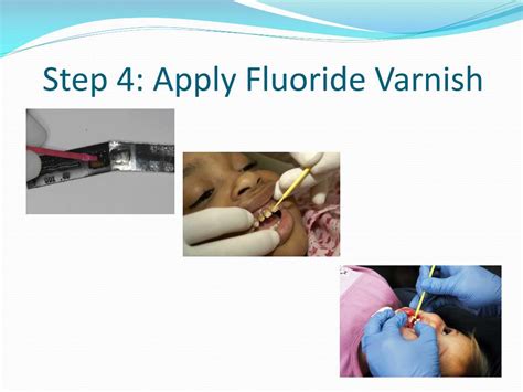 Fluoride Gel Application Procedure At Alexander Feakes Blog