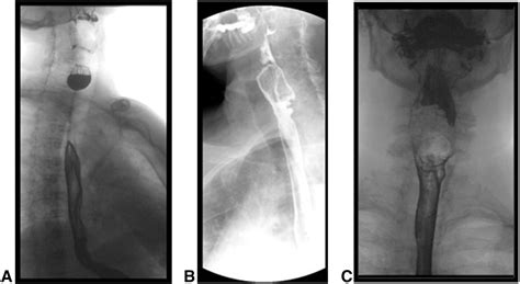 Zenker The American Association For Thoracic Surgery Aats