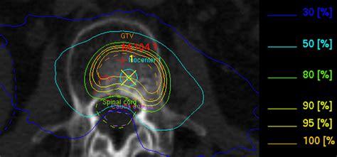Reirradiation Of Spinal Metastases Multileaf Collimator Open Medscience
