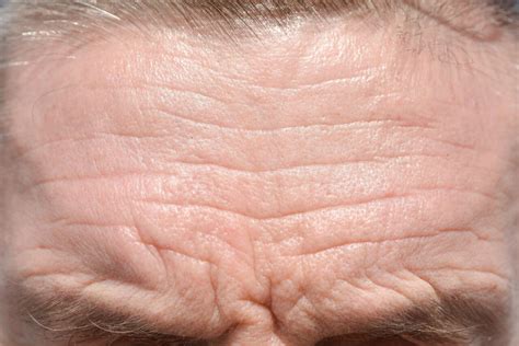 Static Wrinkles Vs Dynamic Wrinkles Whats The Difference Freyja Medical