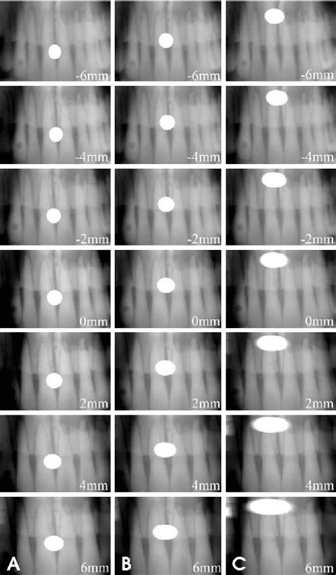 Figure 1 From Quantitative Localization Of Impacted Mesiodens Using Panoramic And Periapical