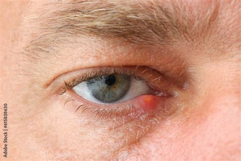 Fotografia Do Stock Close Up Mans Eye With Stye Symptoms Stye