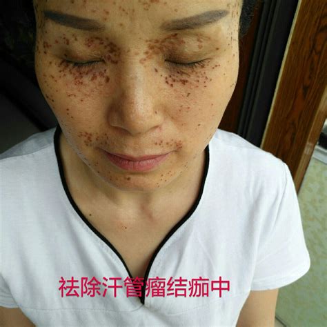 汗管瘤祛除最新方法 知乎