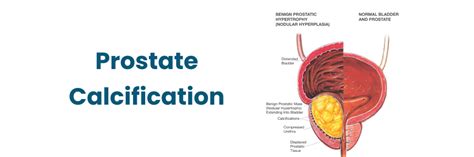 Prostate Calcification Causes And Treatments