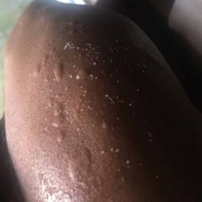 How To Recognise Bed Bug Bites On Black And White Skin Townhustle