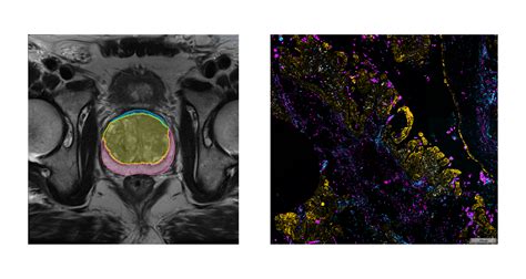 Advancing Cancer Research With Public Imaging Datasets From The National Cancer Institute