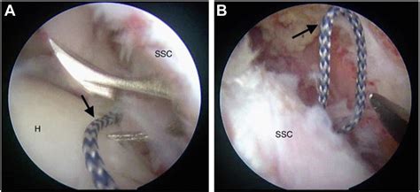 Arthroscopic Lasso Loop Technique For Subscapularis Repair With Anterolateral Viewing Portal