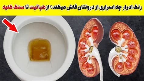 رنگ ادرار در مورد بدن شما به شما چه می گویدبه این موضوع مهم توجه کنید ازهپاتیت تا سنگ کلیه را