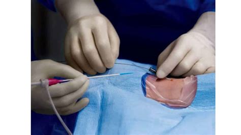 Angioplasty 101 What Every Patient Should Know Before The Procedure