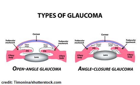 Open Angle Vs Closed Angle Glaucoma