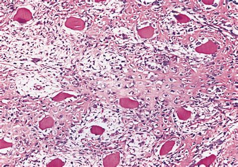 Russells Blog Myositis Ossificans Histology