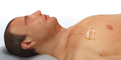 Inspire Implant For Obstructive Sleep Apnea In Patients Who Do Not