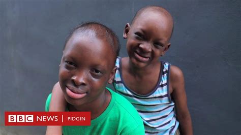 Ectodermal Dysplasia Wetin Di Sickness Be Bbc News Pidgin