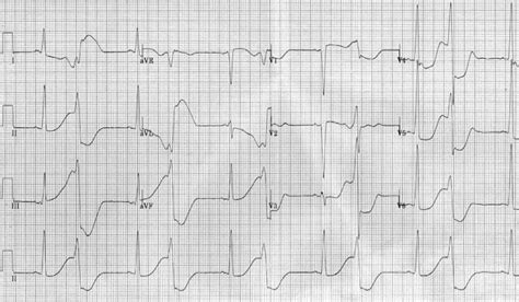 Cardiac Megacode LITFL Clinical Cases Curveball
