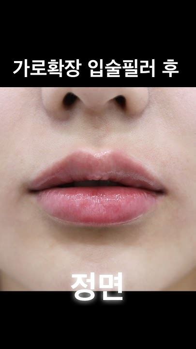 교정으로 말린 입술 고민이라면 가로확장입술필러 Youtube