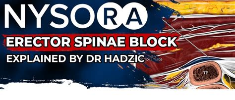 Erector Spinae Block Esb Explained Nysora
