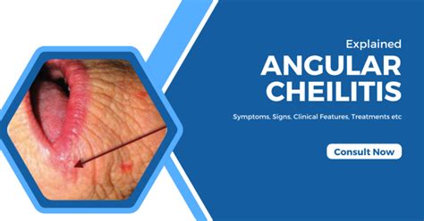 Angular Cheilitis Diagnosis Treatments Clinical Features And More