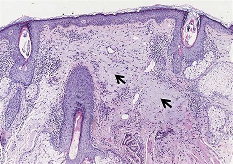 Figure 2 From Solar Elastosis In Its Papular Form Uncommon Mistakable