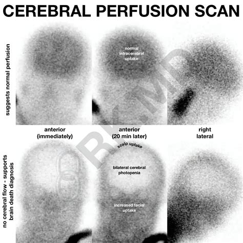 Cerebral Perfusion Scans And Brain Death Rk Md