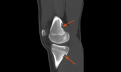 Ct Scans For Knee Injuries