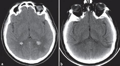 Symptomatic Bilateral Xanthogranuloma Of The Choroid Plexus Abstract