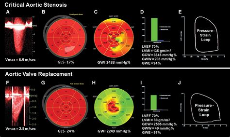 Myocardial Work In Echocardiography Circulation Cardiovascular Imaging