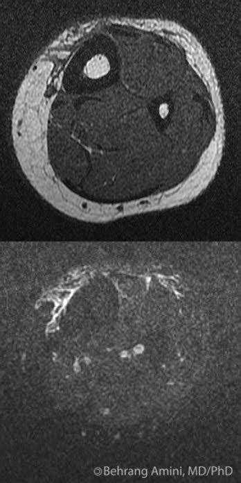 Roentgen Ray Reader Shin Splints Vs Stress Fracture On Mri