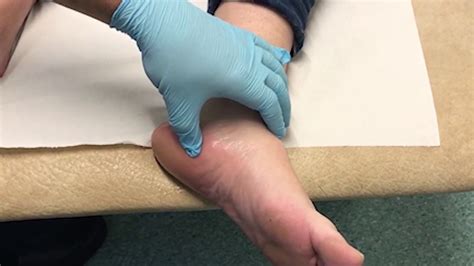 Plantar Fasciitis Injection Technique