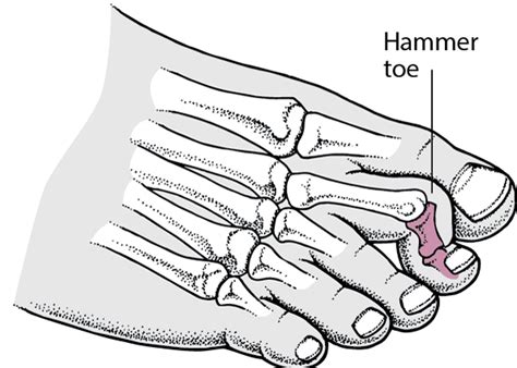 Hammer Toe Bone Joint And Muscle Disorders Msd Manual Consumer Version