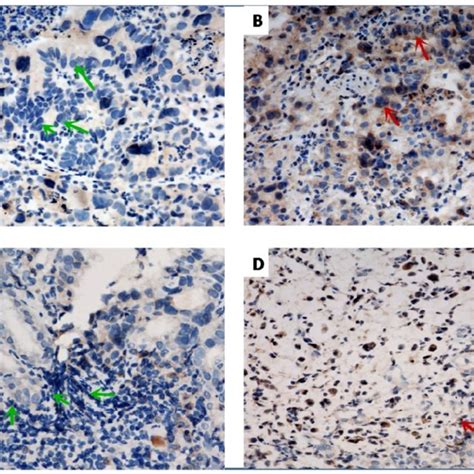 The Expression Of Pd L1 In Patients With Gastric Cancer Download Table