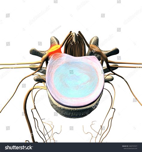 Herniated Disc Pressing Against Spinal Nerve Stock Illustration