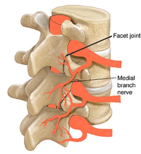 Medial Branch Blocks Spines Dorset