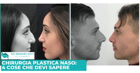 Chirurgia Plastica Naso 4 Cose Che Devi Sapere • My Rhinoplasty