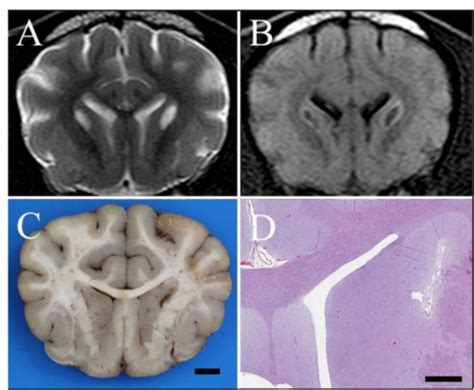 Mitochondrial Disease Flashcards Quizlet