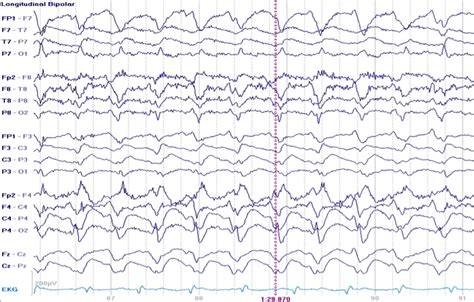Unusual Eeg Presentation Of Epileptic Nystagmus