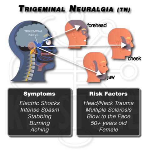 Trigeminal Neuralgia Treatment In Charlotte Nc Trigeminal Neuralgia Treatment In Charlotte Nc