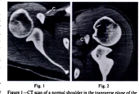 Structure Of Coracoid Process Of Scapula Semantic Scholar