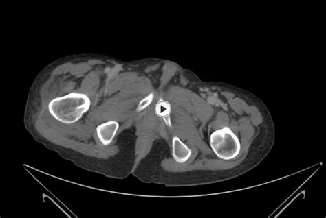 Tb Myositis The Same Patient As In Fig 16 Axial Ct Scan Images Show