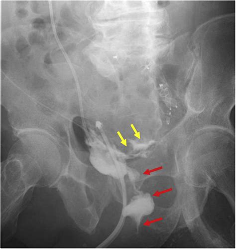 Urethrography Performed 18 Days After The Open Surgery The Contrast