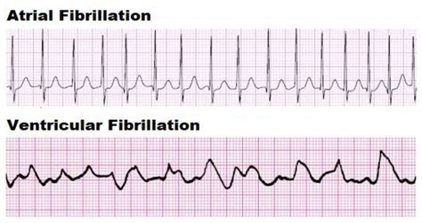 mathematics free full text prediction and analysis of heart diseases using heterogeneous