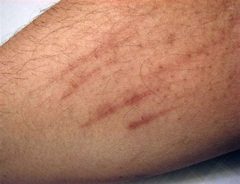 What Is The Worst Injury You Ve Suffered During Sex Quora