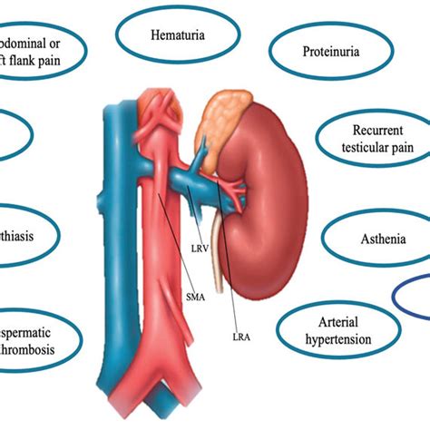 Main Clinical Features Of The Nutcracker Syndrome Abbreviations Lrv Download Scientific