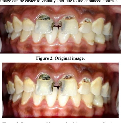 Stone And Smooth Tooth Surface At Steven Obrien Blog