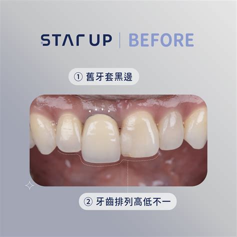 全瓷冠療程 Ms 張改善變色門牙的困擾 星創牙醫診所