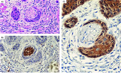 Perineural Invasion 40x Tumor Cells Are Close To The Nerve Download Scientific Diagram