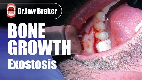 Bone Growth In Your Gums At Emma Sparks Blog