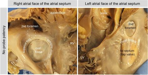 Interatrial Septum
