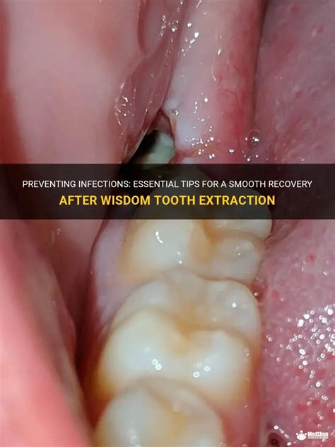 Preventing Infections Essential Tips For A Smooth Recovery After Wisdom Tooth Extraction Medshun