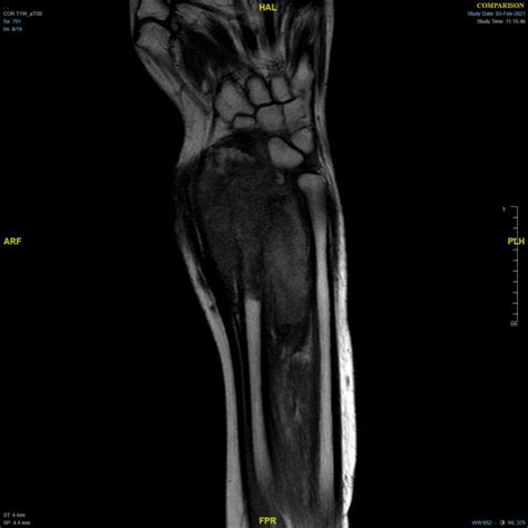 Unusual Location Of Bone Tumor Easily Misdiagnosed Distal Radius